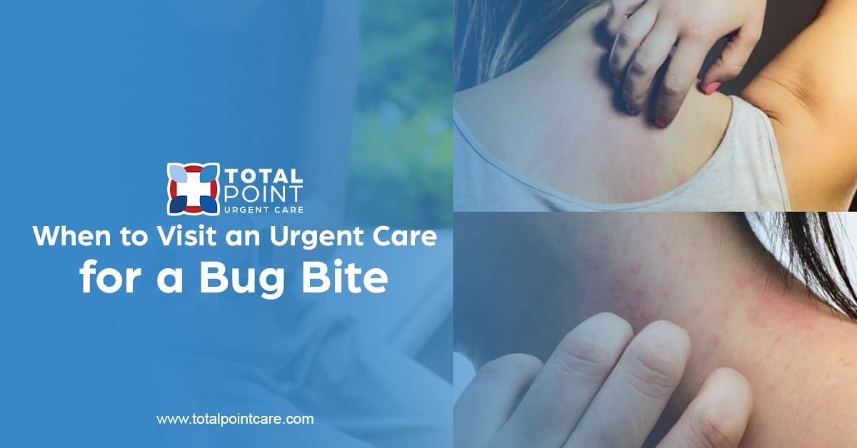 When to Visit an Urgent Care for a Bug Bite | Total Point Care